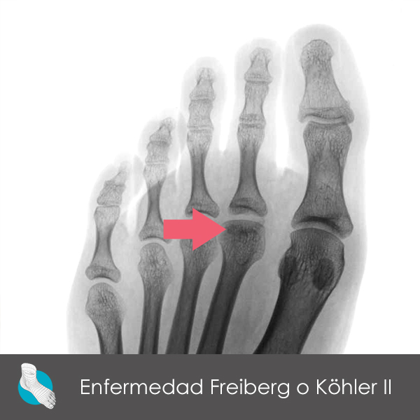 Enfermedad Freiberg o Köhler II