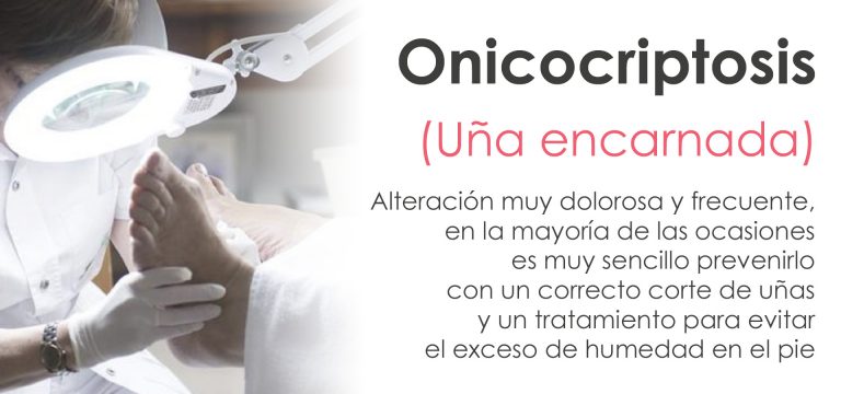 Onicocriptosis (Uña encarnada)