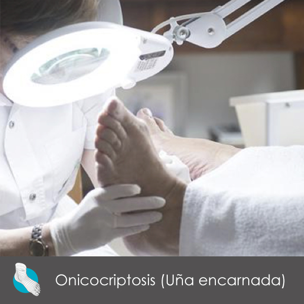 Onicocriptosis (Uña encarnada)