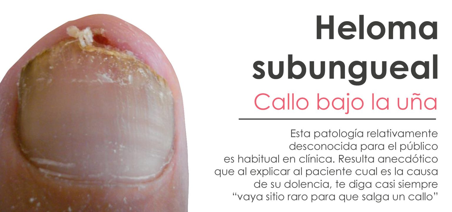 Heloma subungueal (callo bajo la uña)