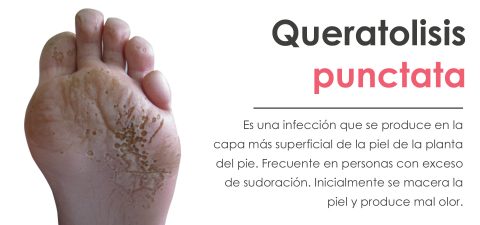 Queratolisis punctata