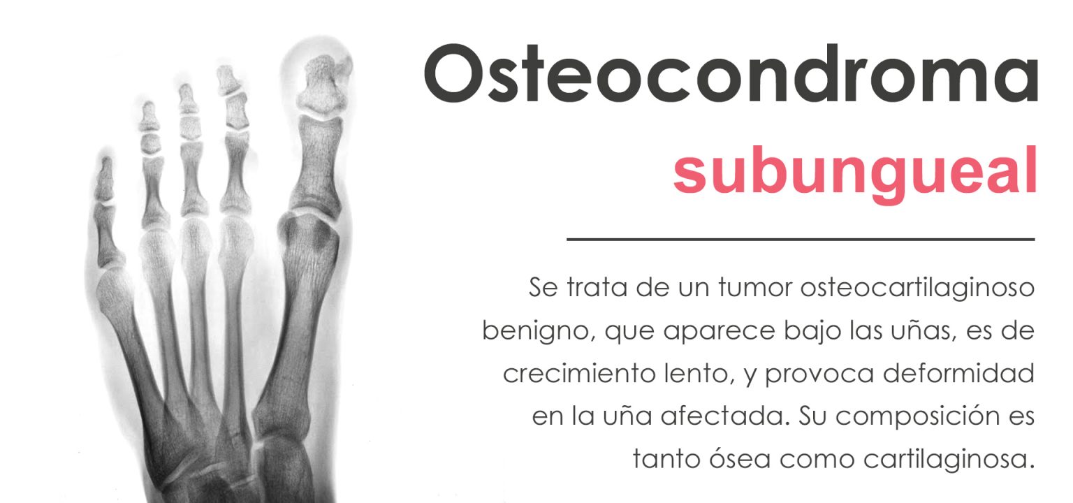 Osteocondroma