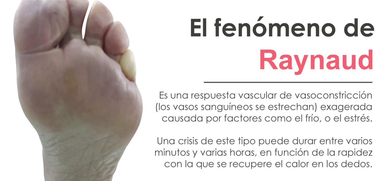 El fenómeno de Raynaud